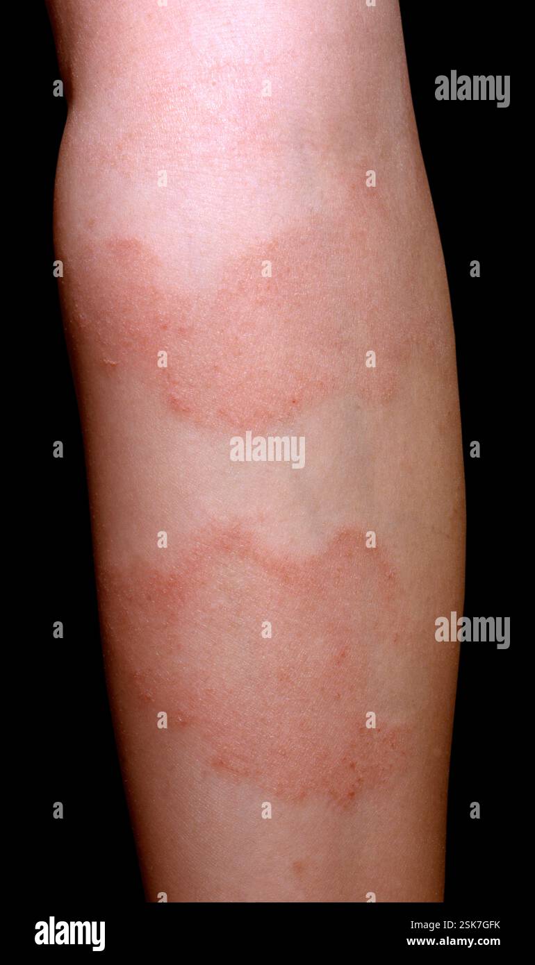 Seborrheic dermatitis on the arm of a 20 year old female patient. This ...