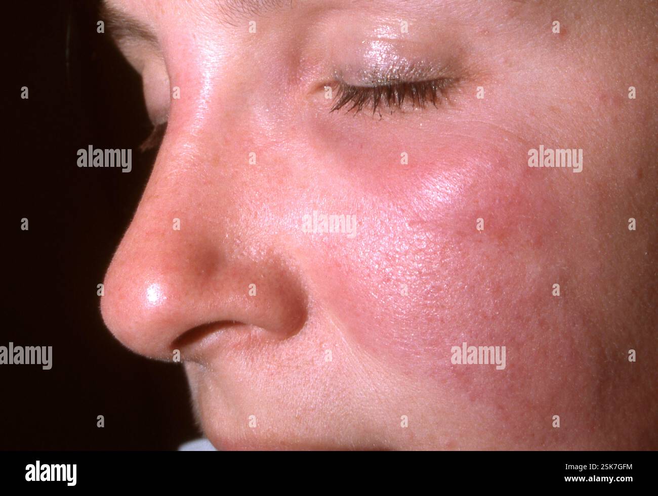 Reddened skin on the face of a 30 year old female patient with ...