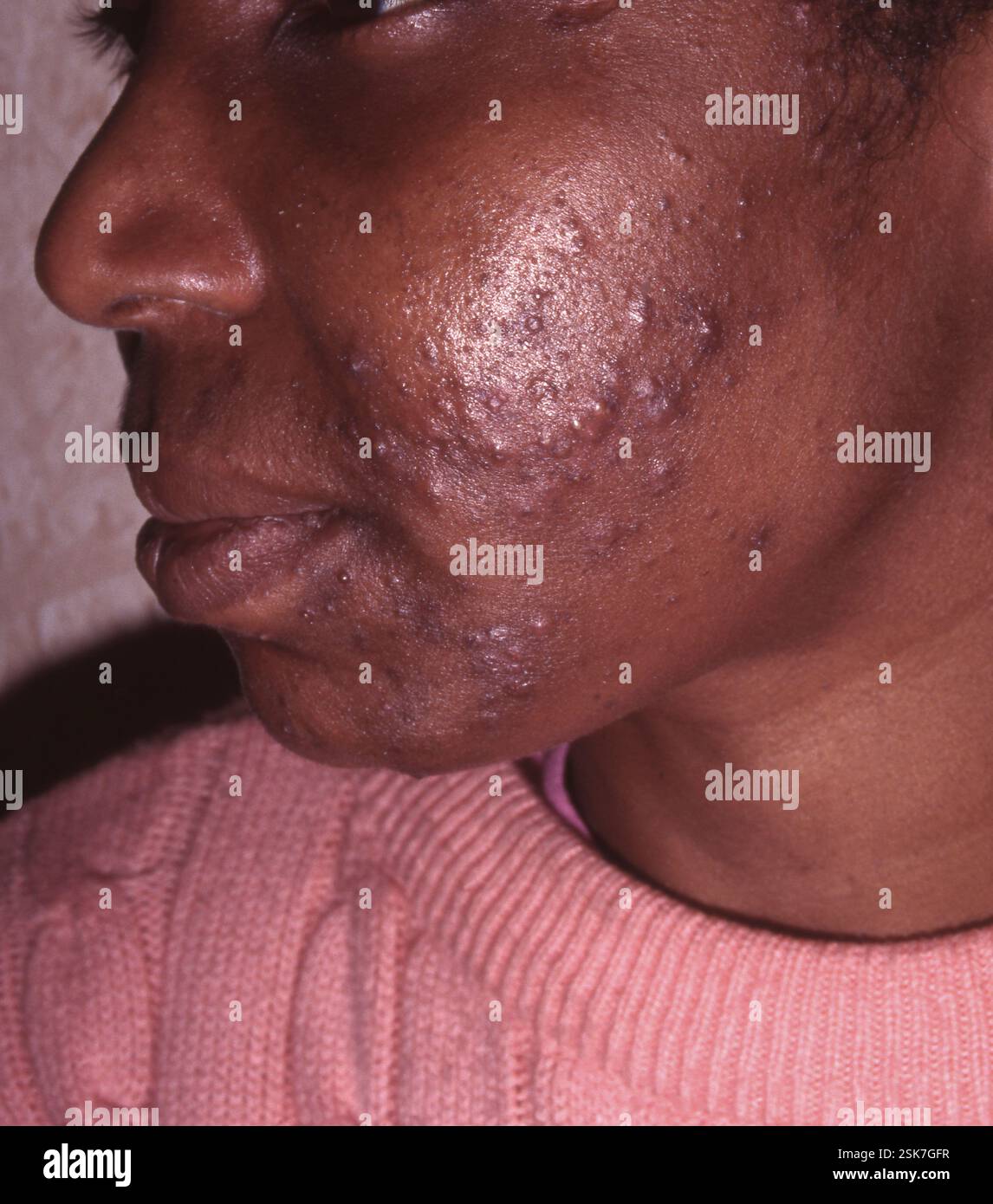 Acne vulgaris on the face of a 21 year old female patient. Acne ...