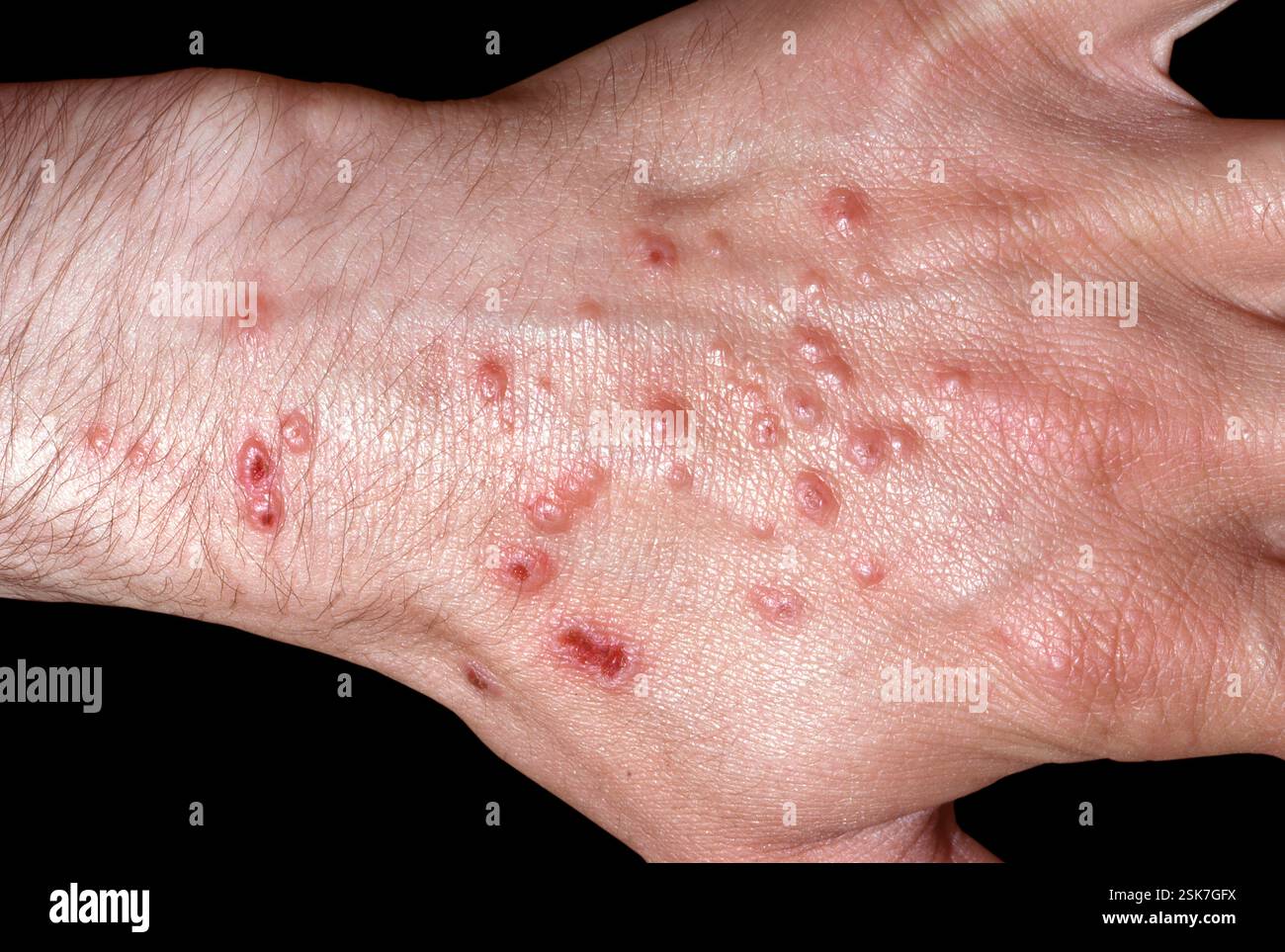 Erythema multiforme lesions on the hand and wrist of a 29 year old male ...