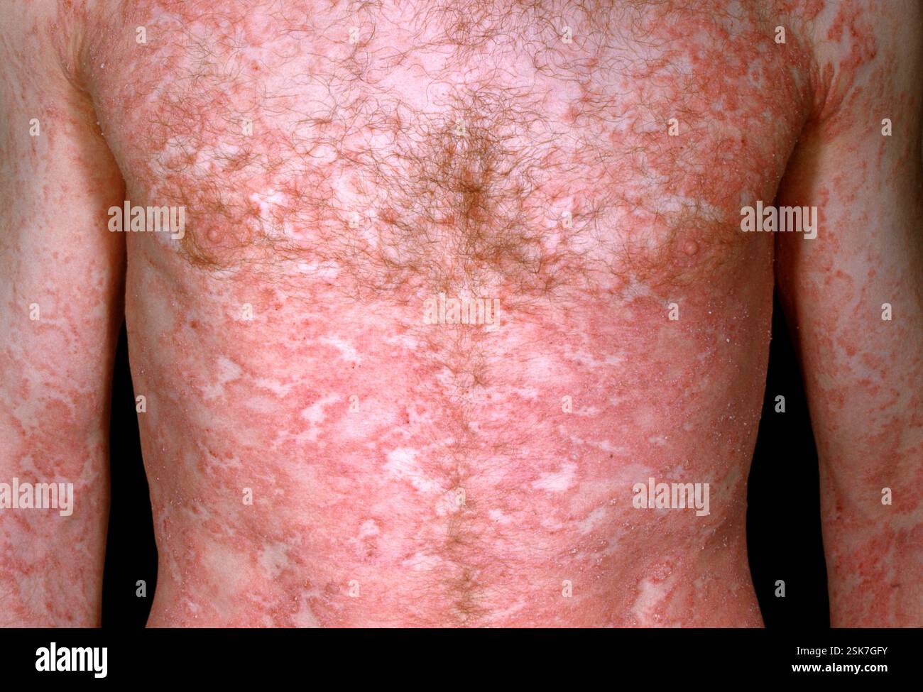 Drug eruption rash on the thorax of a 34 year old male patient Stock ...