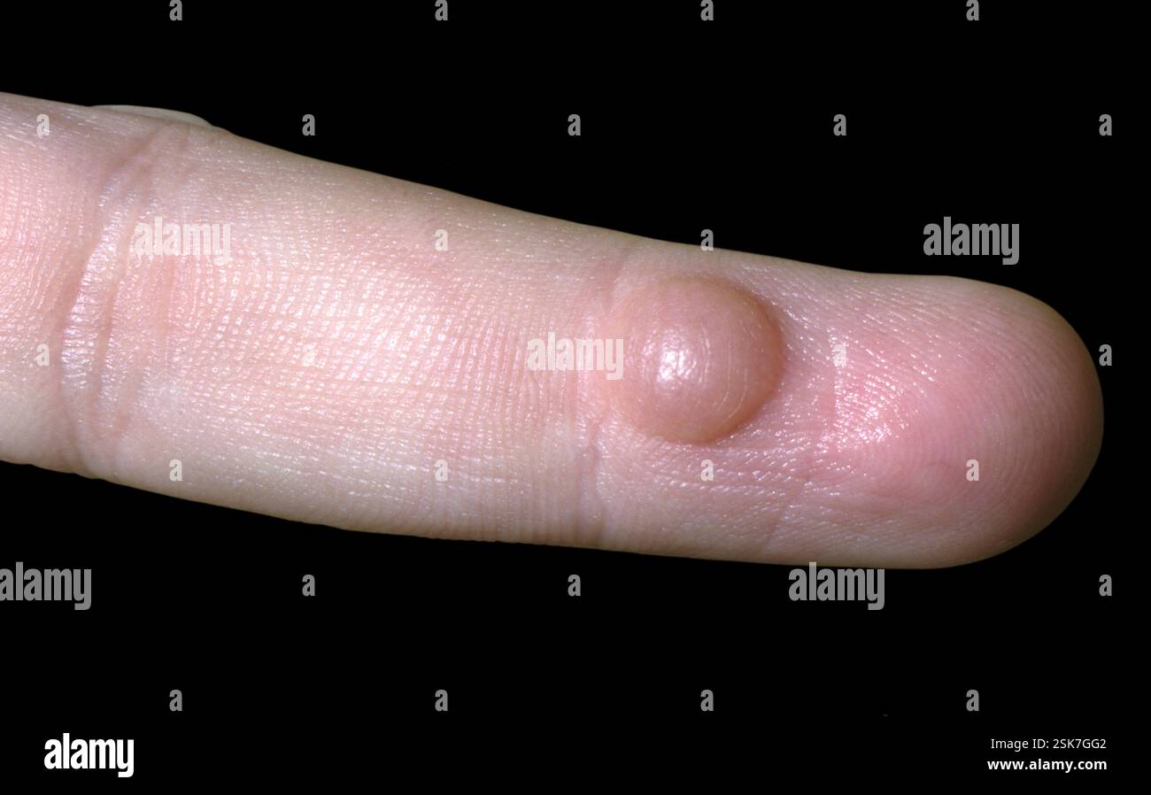 Fibroma on the finger of a 40 year old male patient. Fibromas are ...