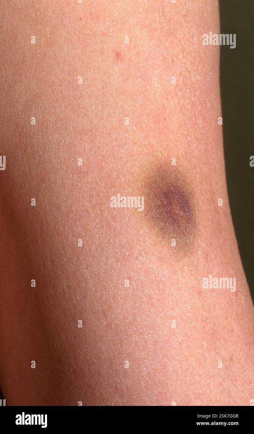 Bruise on a female patient with painful bruising syndrome, also known ...