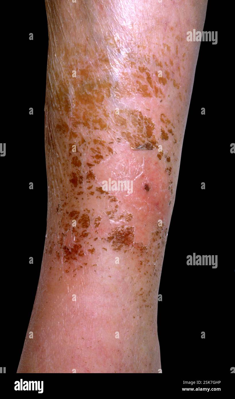 Varicose eczema on the leg of a 31 year old female patient. This ...