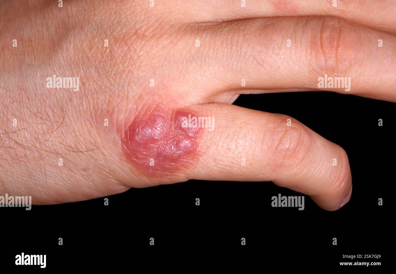 Aquarium granuloma lesion on the hand of a 20 year old male patient ...