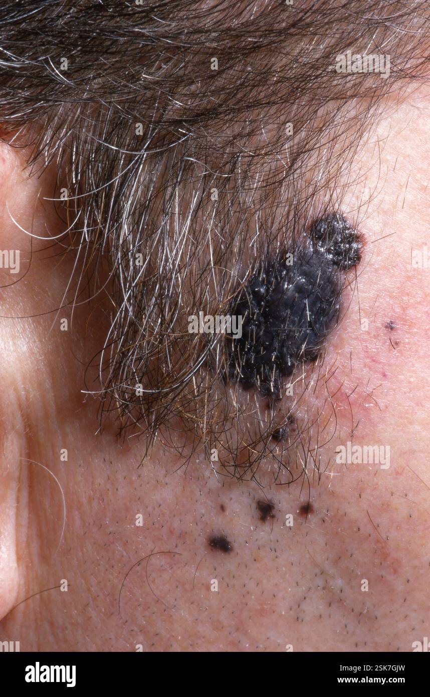 Malignant melanoma on the temple of a 46 year old male patient ...