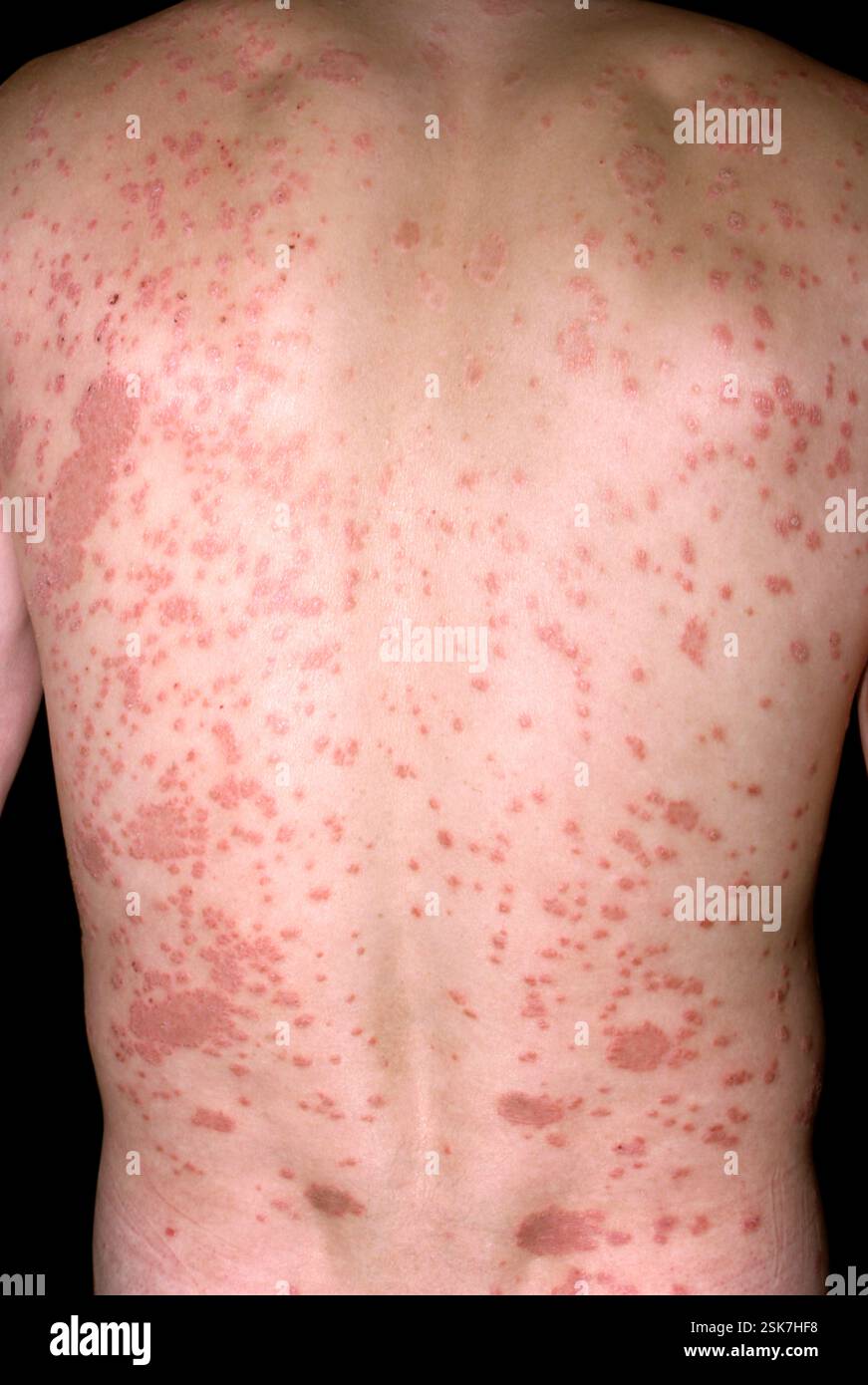 Psoriasis on the back of a 45 year old male patient. Psoriasis is a ...