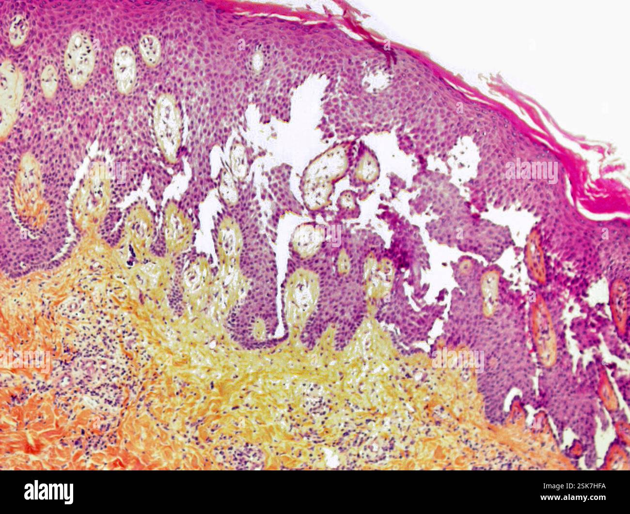 Light micrograph showing skin tissue affected by pemphis vulgaris ...