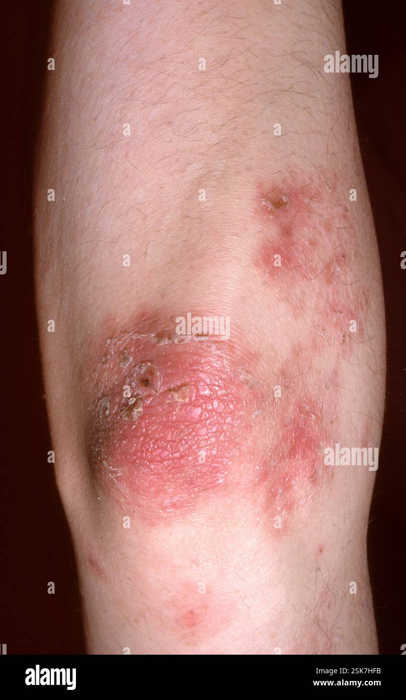 Bullous pemphigoid on the elbow of a 44 year old male patient. This ...