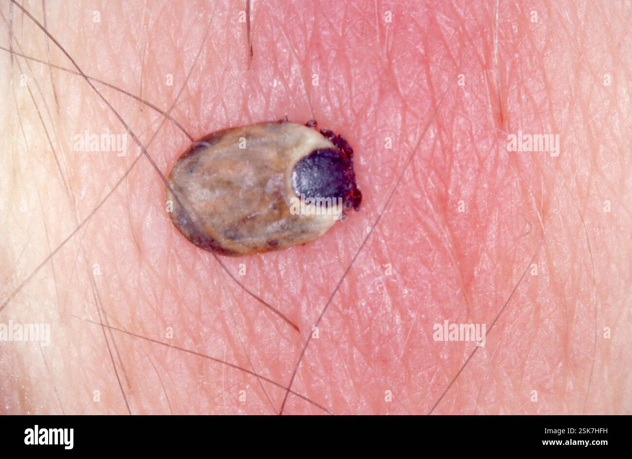 Lyme disease, or sheep, tick (Ixodes ricinus) feeding on the blood of a ...