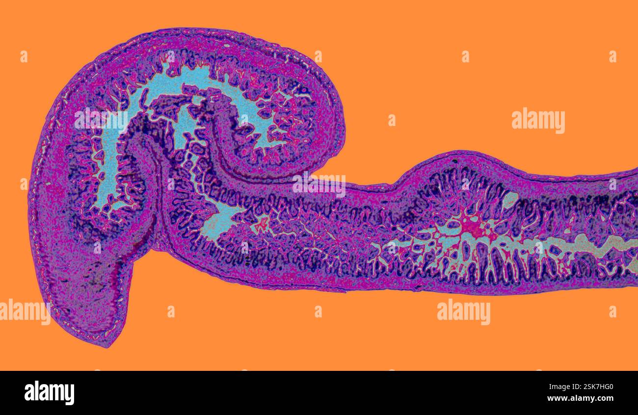 Light micrograph of a healthy Ileocaecal valve (Bauhin's valve), a ...