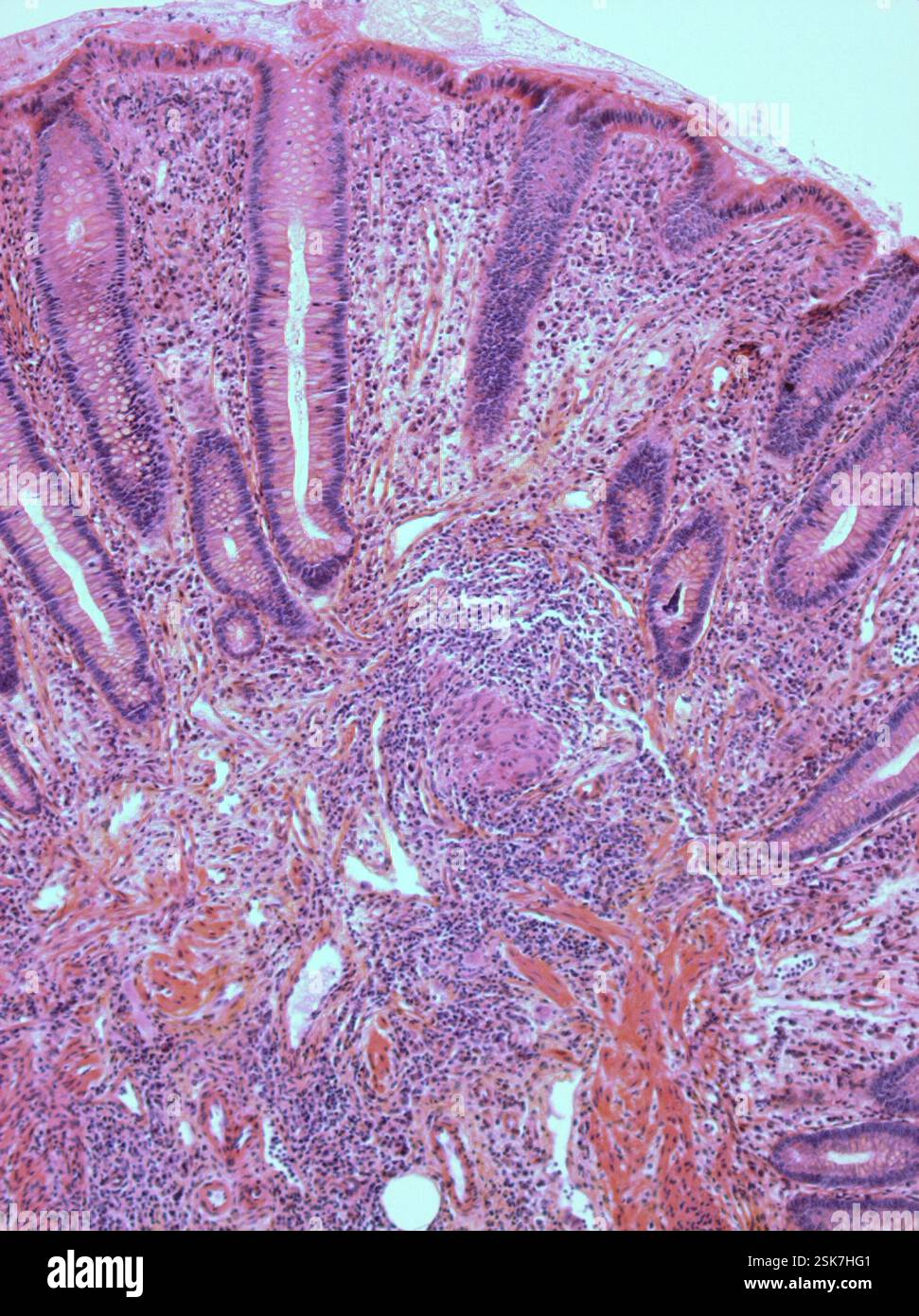 Light micrograph of stomach tissue from a patient with Crohn's disease ...