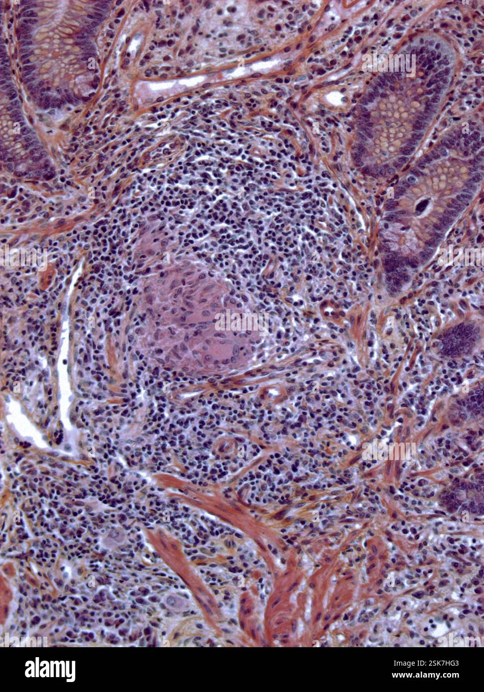Light micrograph of stomach tissue from a patient with Crohn's disease ...