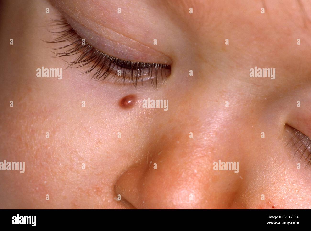 Juvenile xanthogranuloma (JXG) under the eye of a 6 year old girl. JXG ...