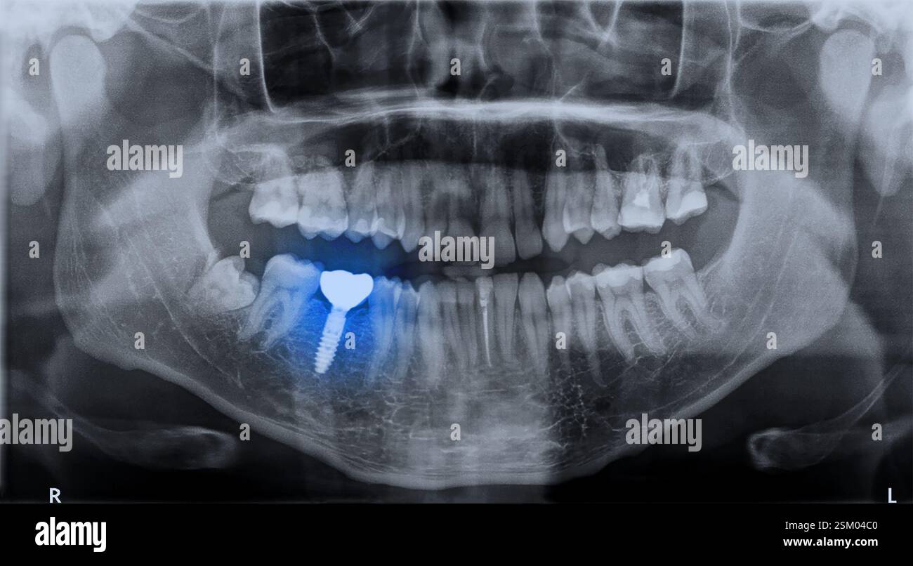 Panoramic dental x-ray image mouth of adult man and single dental ...