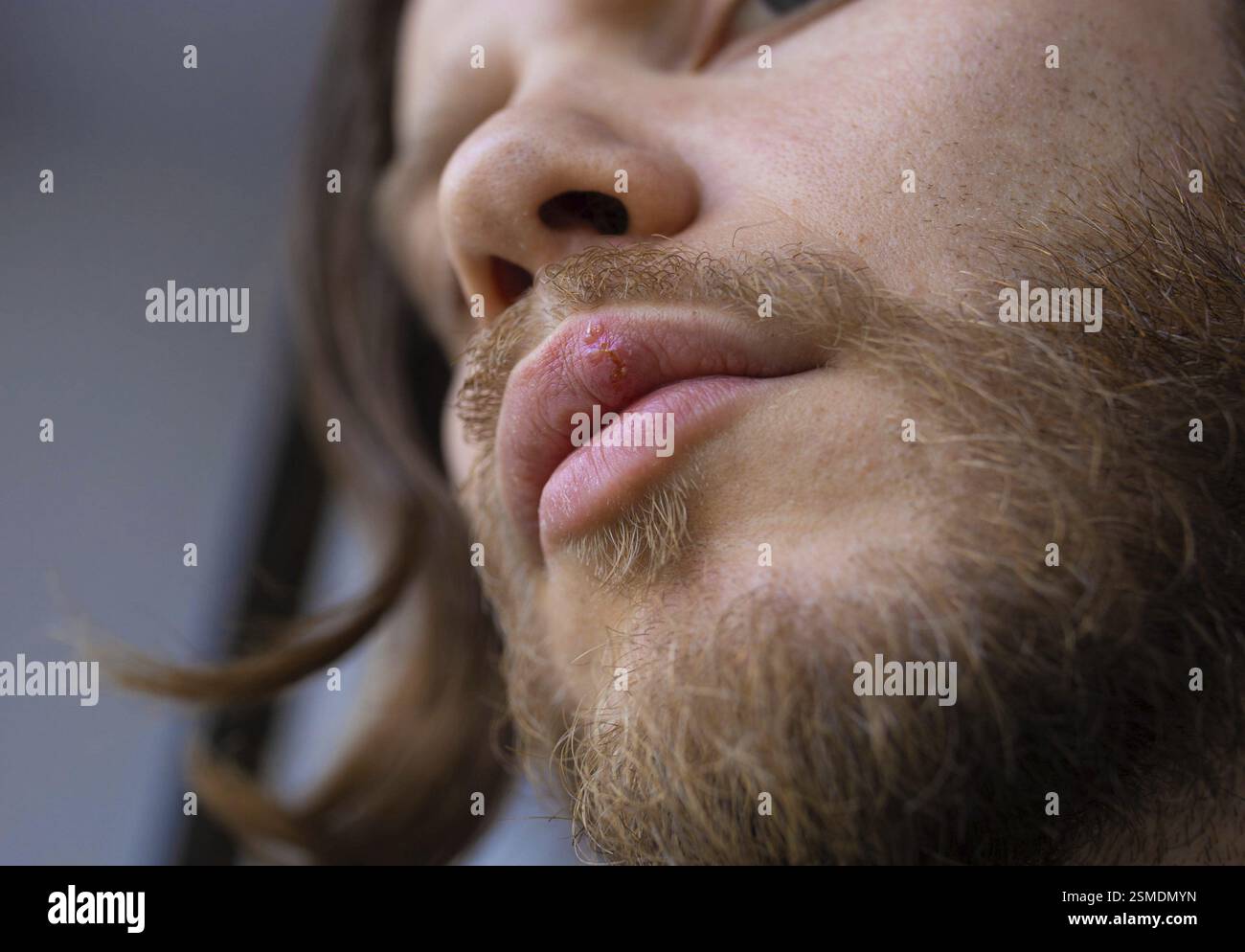 Close-up side view of a man's face, focusing on a cold sore on his lips ...