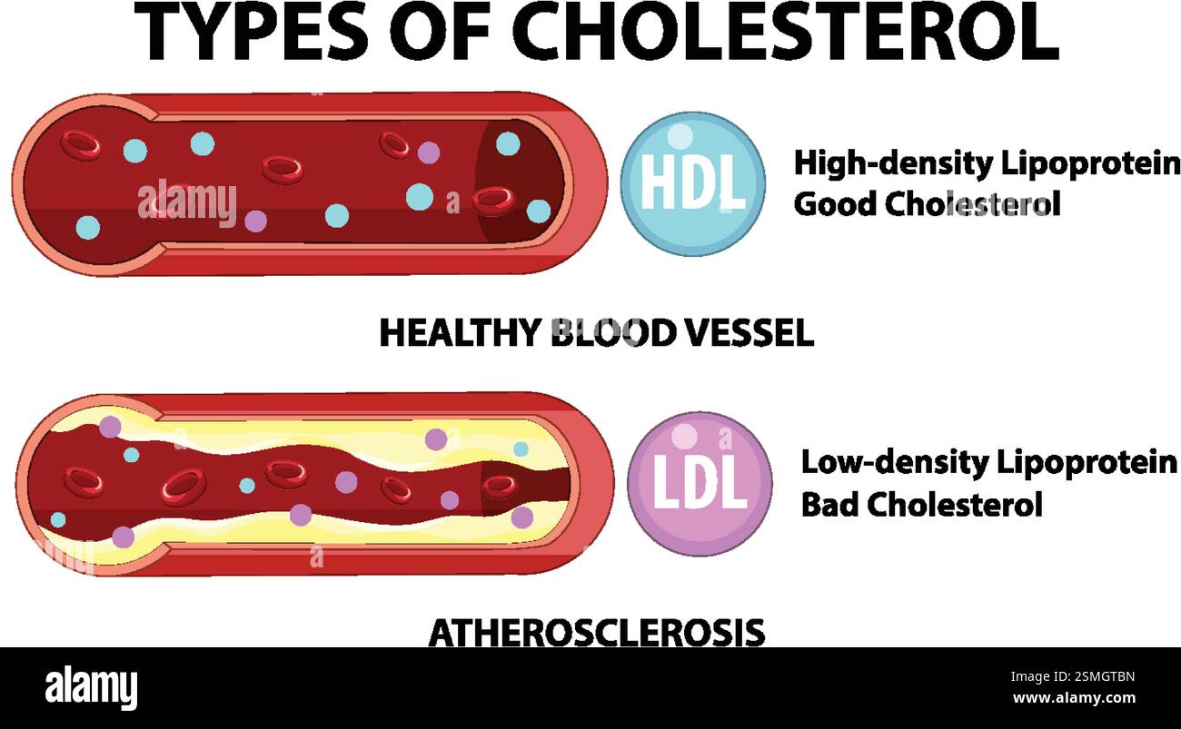 Illustration of cholesterol types in blood vessels Stock Vector Image ...