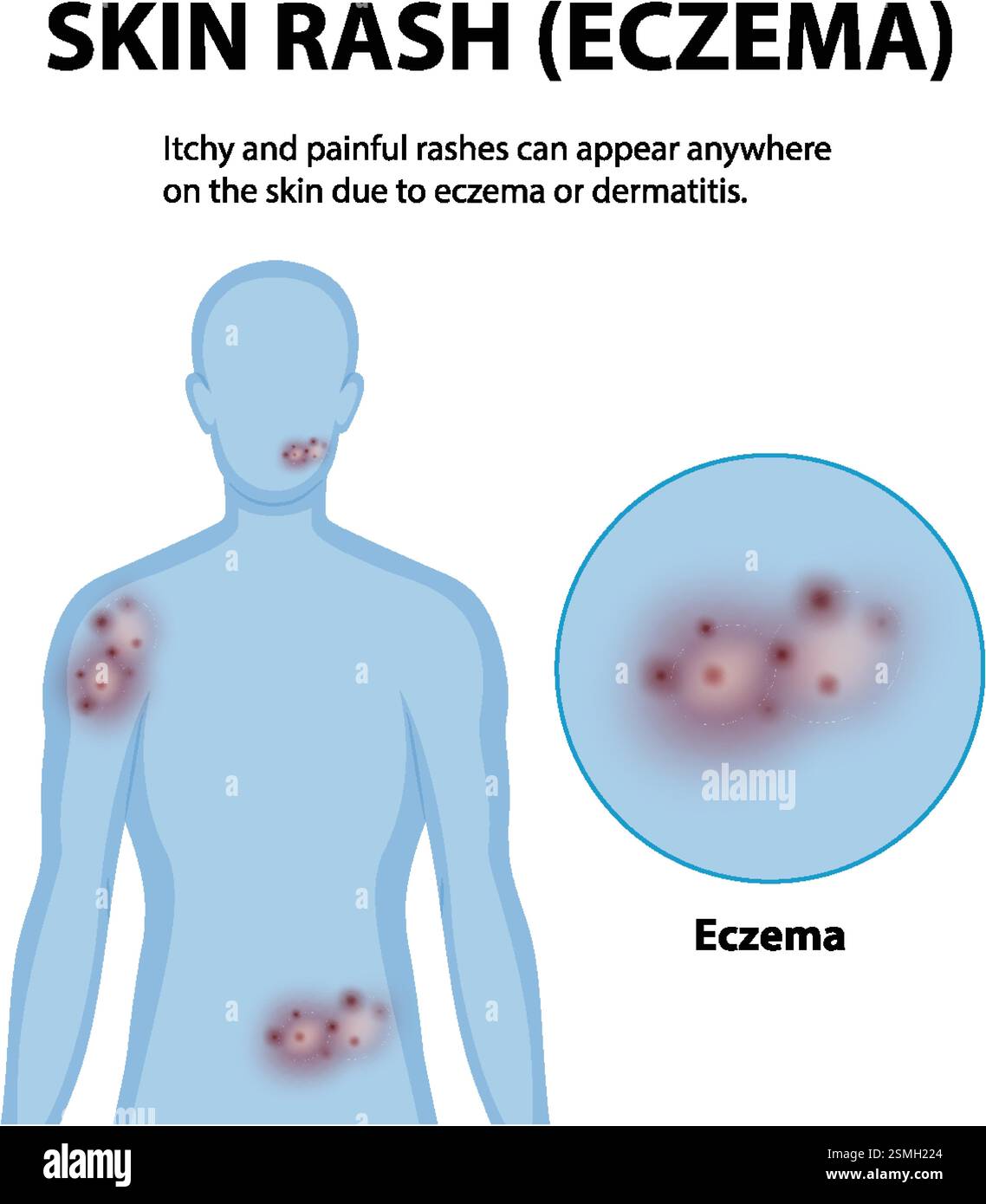 Allergy on human body Cut Out Stock Images & Pictures - Alamy