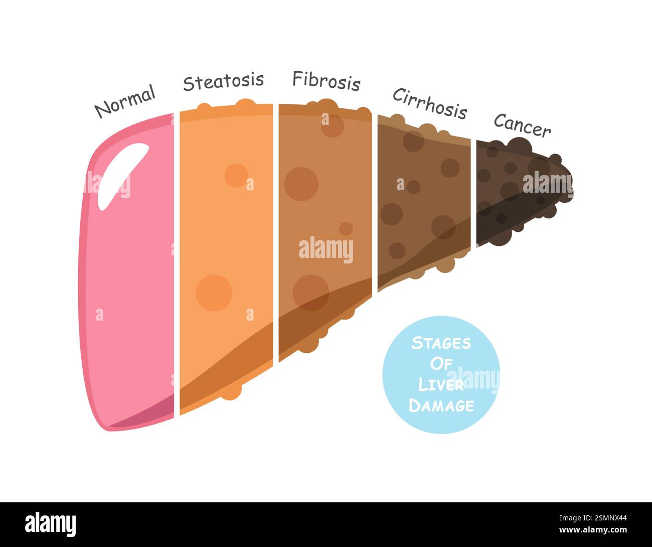 Stages of liver damage include steatosis or fatty liver, fibrosis ...