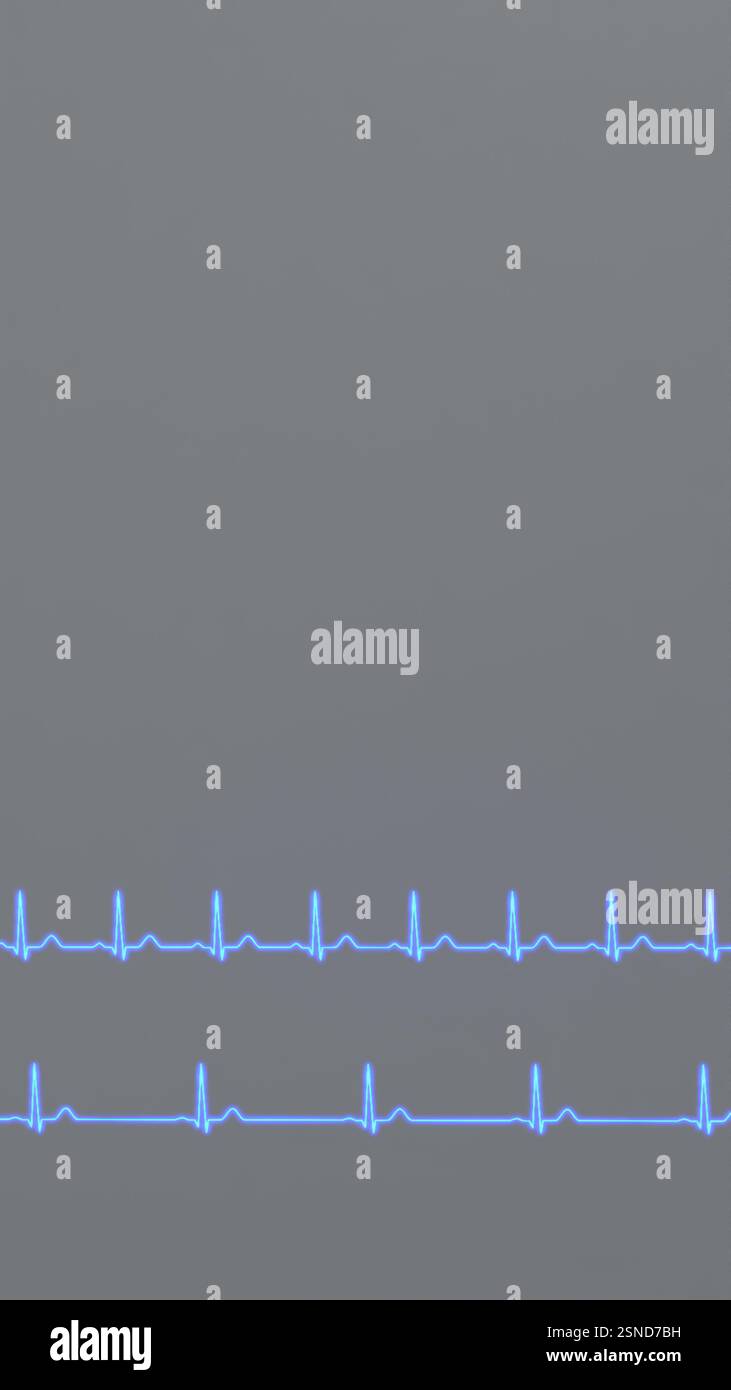 Comparison of ECG of normal heart rhythm and bradycardia Stock Photo ...