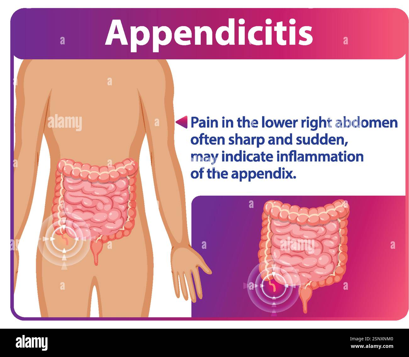 Illustration of appendicitis symptoms and affected area Stock Vector Image & Art - Alamy