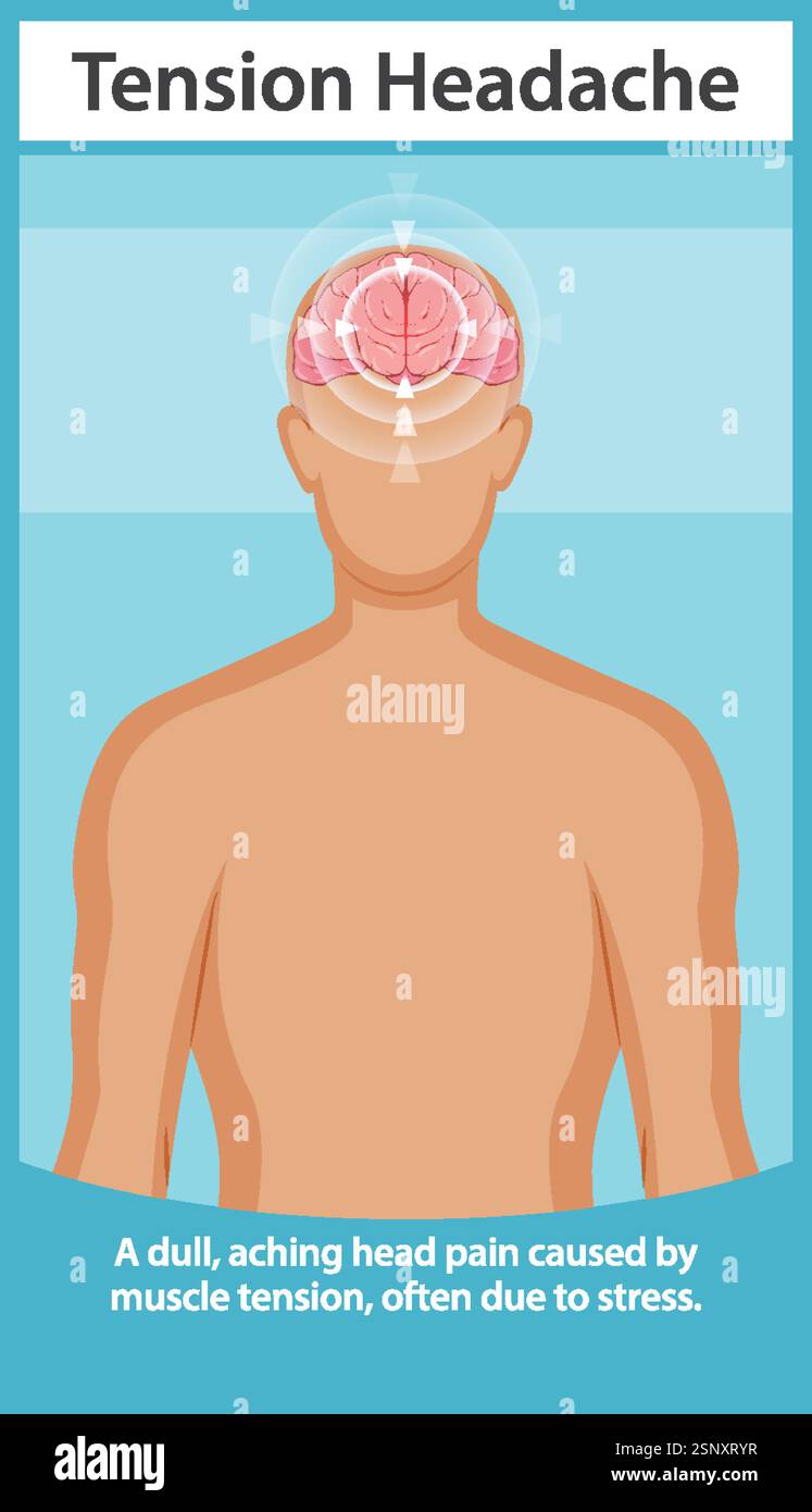 Illustration of tension headache caused by stress Stock Vector Image ...