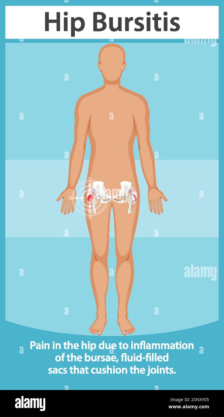 Illustration of hip bursitis and joint inflammation Stock Vector Image ...