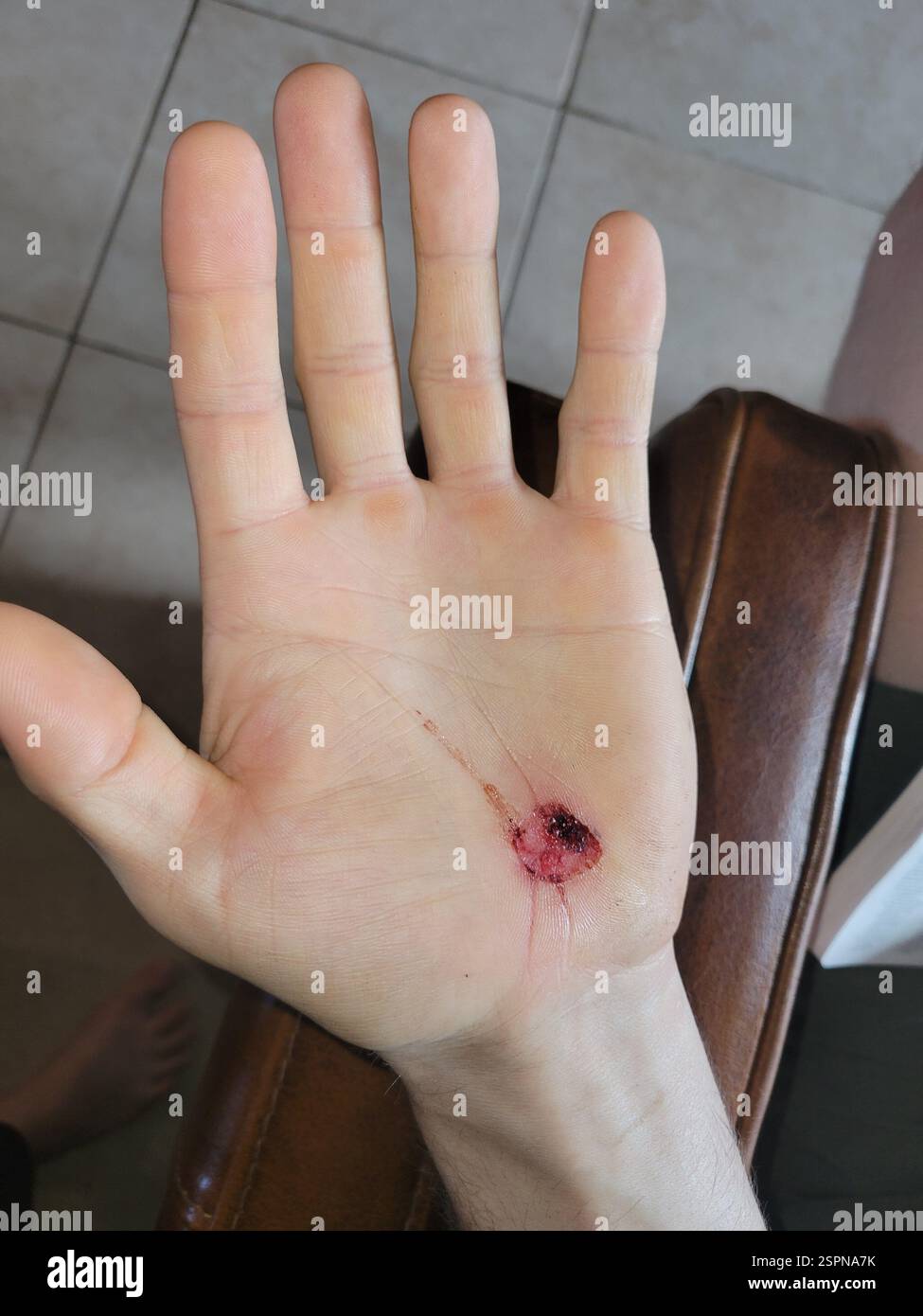 A visible wound on the hand indicates there has been an injury and it ...