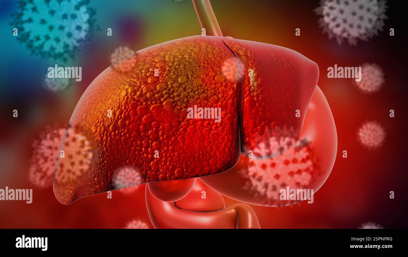 Hepatitis Leading to Acute Liver Failure Stock Photo - Alamy