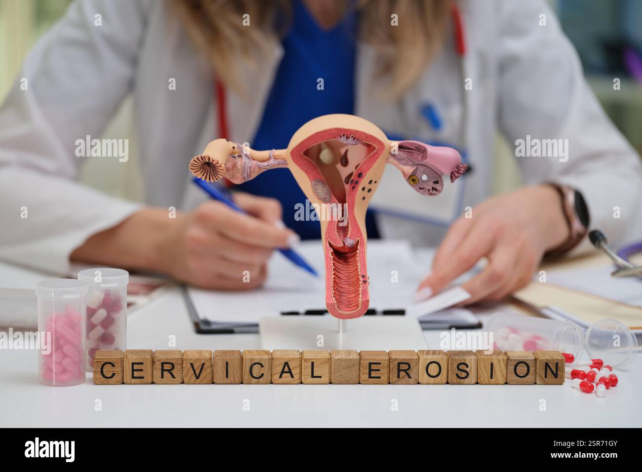 A Comprehensive Understanding of Cervical Erosion Medical Insights and ...