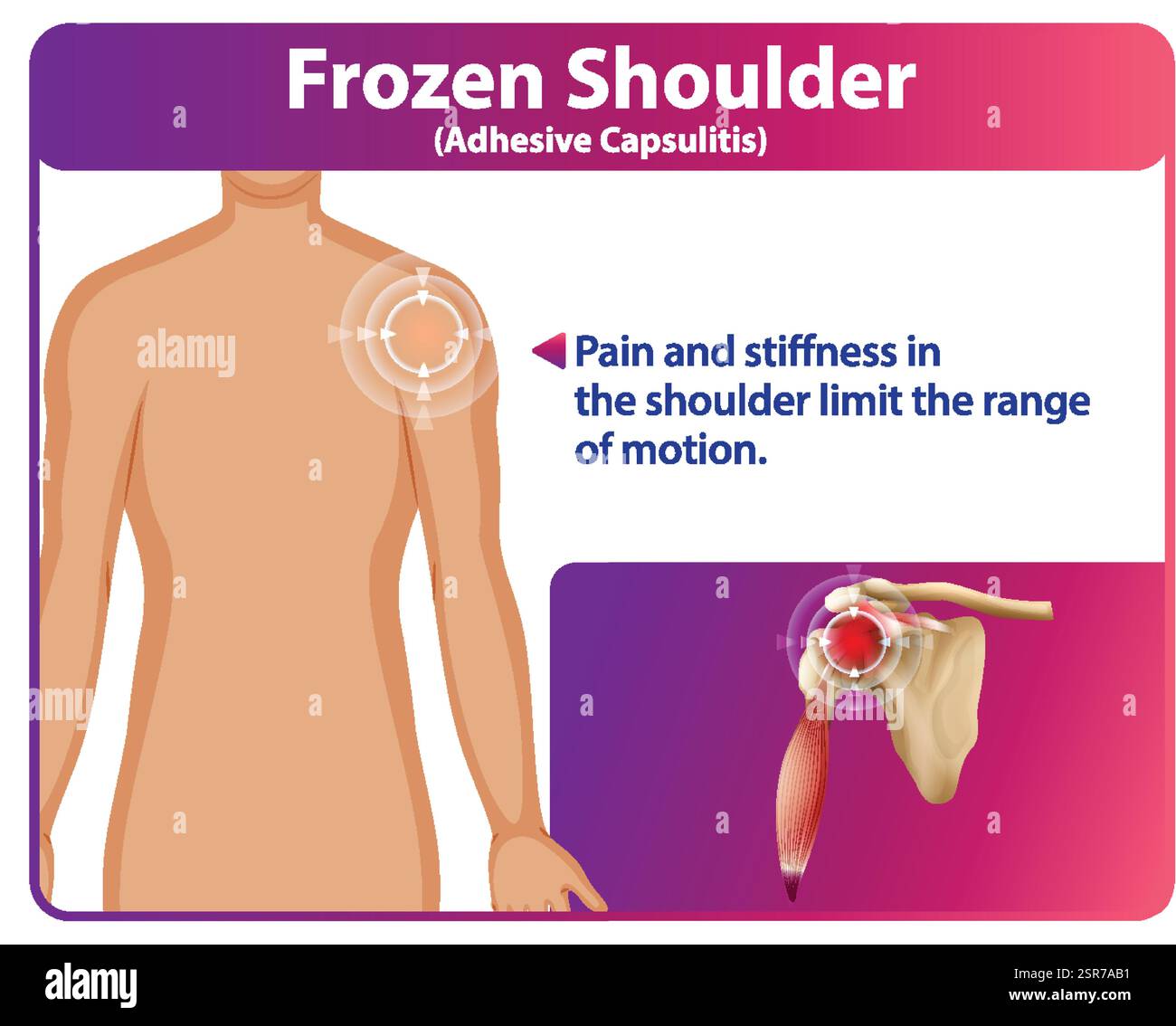 Illustration of frozen shoulder and its symptoms Stock Vector Image & Art - Alamy