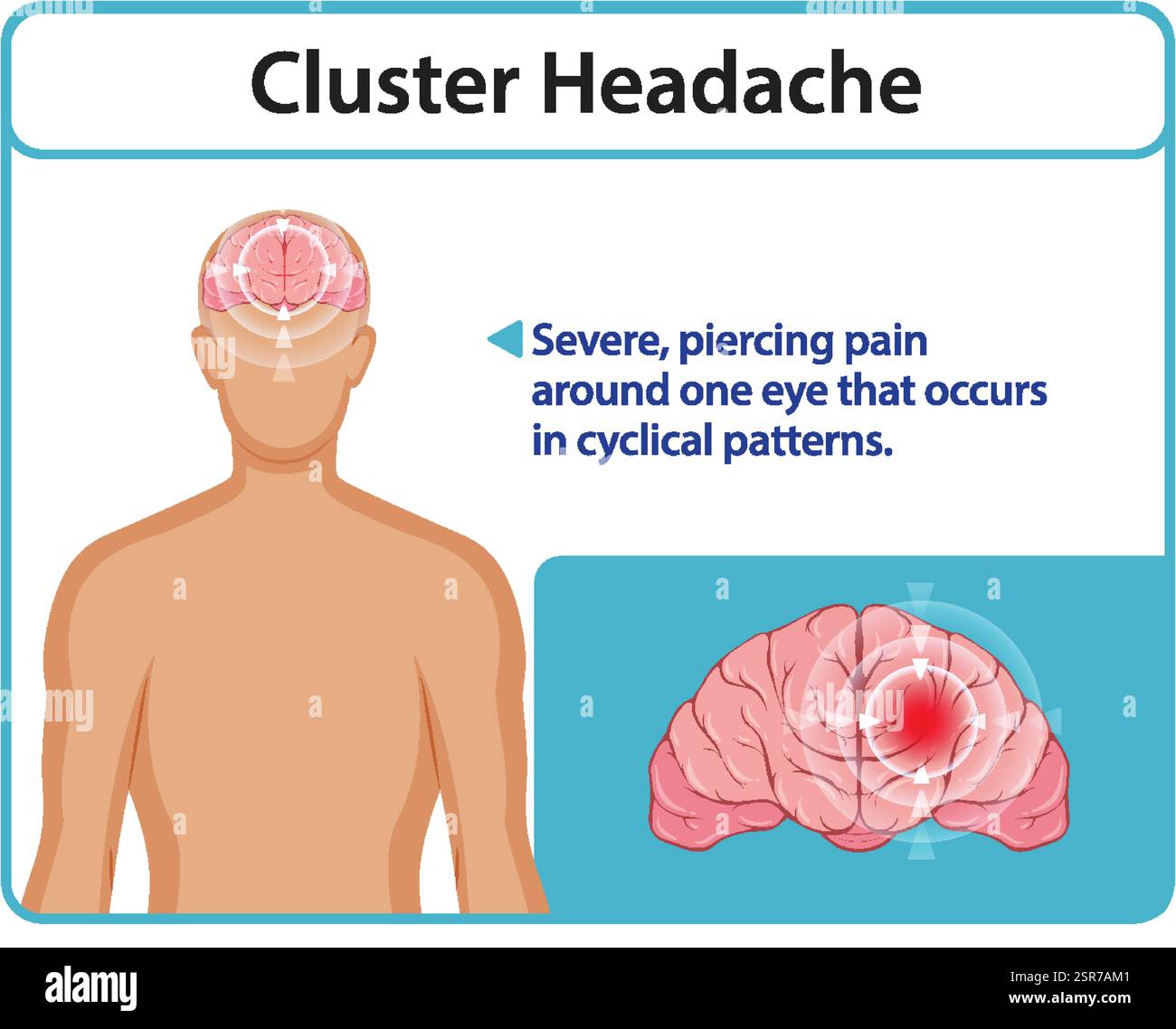 Illustration of cluster headache pain and brain area Stock Vector Image ...