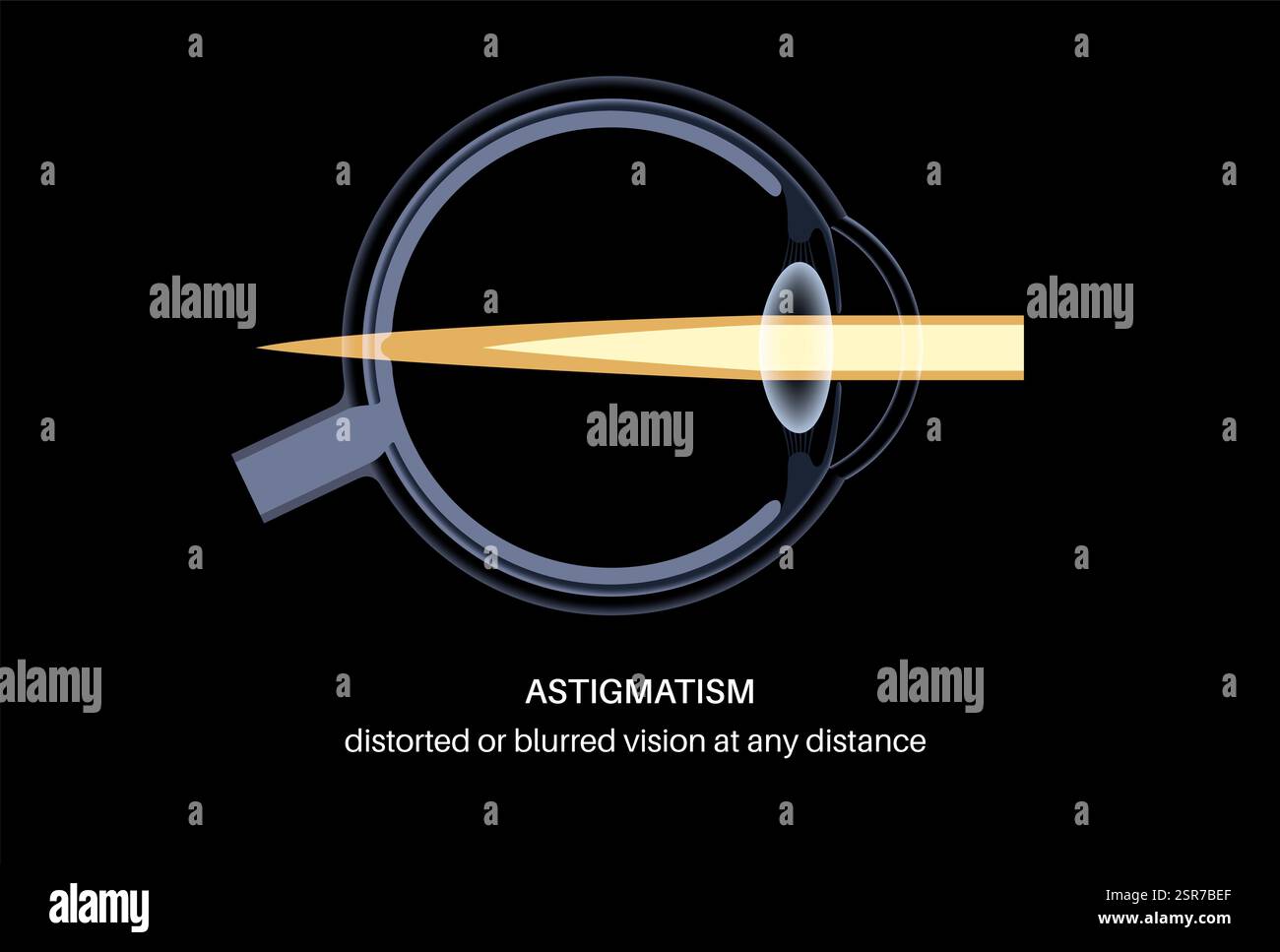 Illustration of the astigmatism eye condition. Astigmatism is an ...