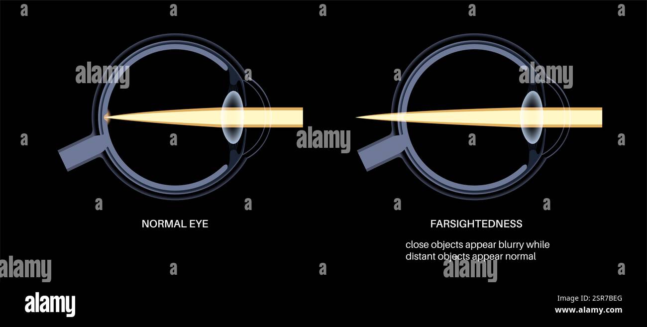 Illustration of farsightedness. Farsightedness, or hyperopia, is a ...
