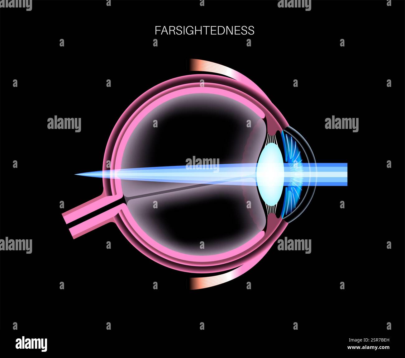 Illustration of farsightedness. Farsightedness, or hyperopia, is a ...