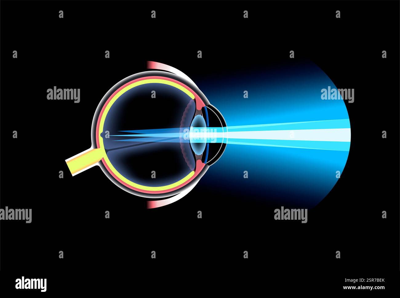 Illustration of the astigmatism eye condition. Astigmatism is an ...