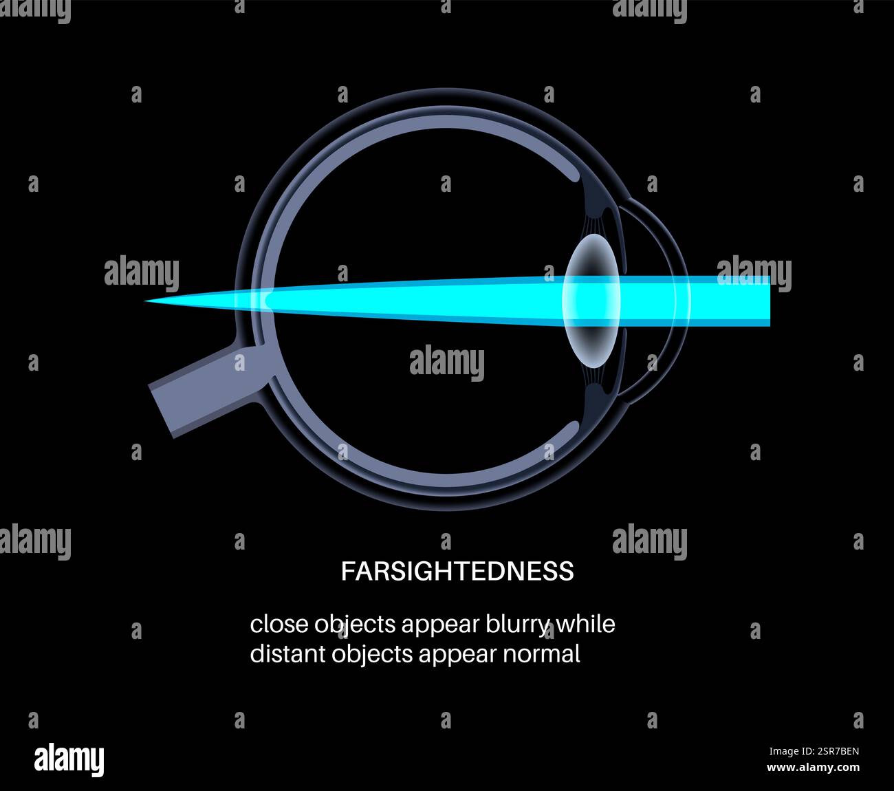 Illustration of farsightedness. Farsightedness, or hyperopia, is a ...