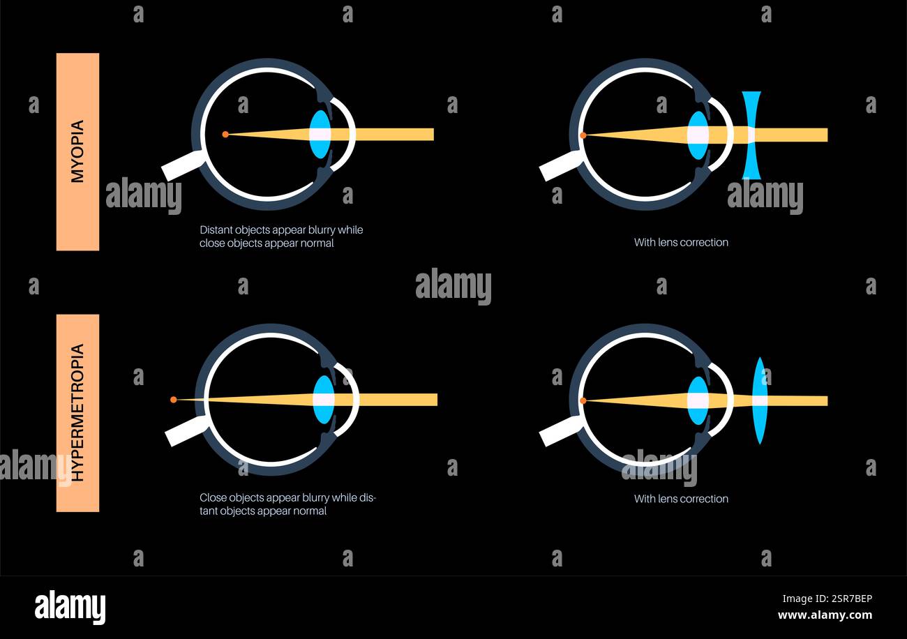 Illustration of nearsightedness and farsightedness vision correction. Nearsightedness, or myopia ...