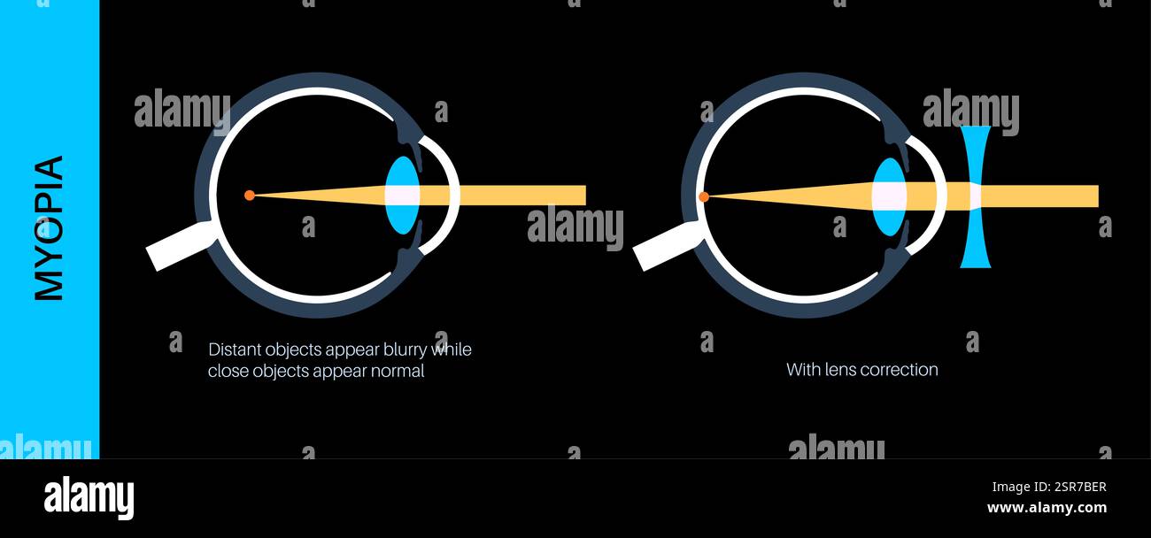 Illustration of an eye with nearsightedness. Nearsightedness is a ...