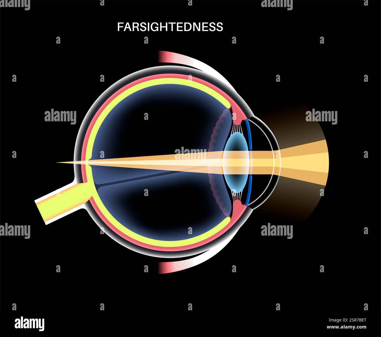 Illustration of farsightedness. Farsightedness, or hyperopia, is a ...