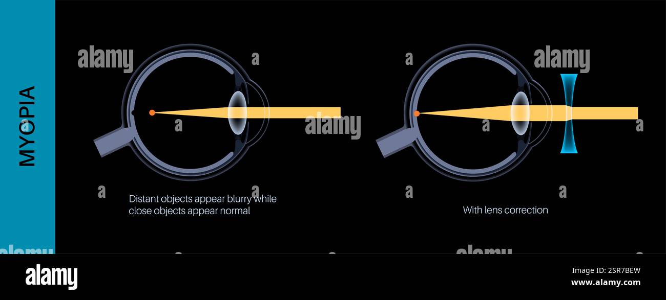 Illustration of an eye with nearsightedness. Nearsightedness is a ...