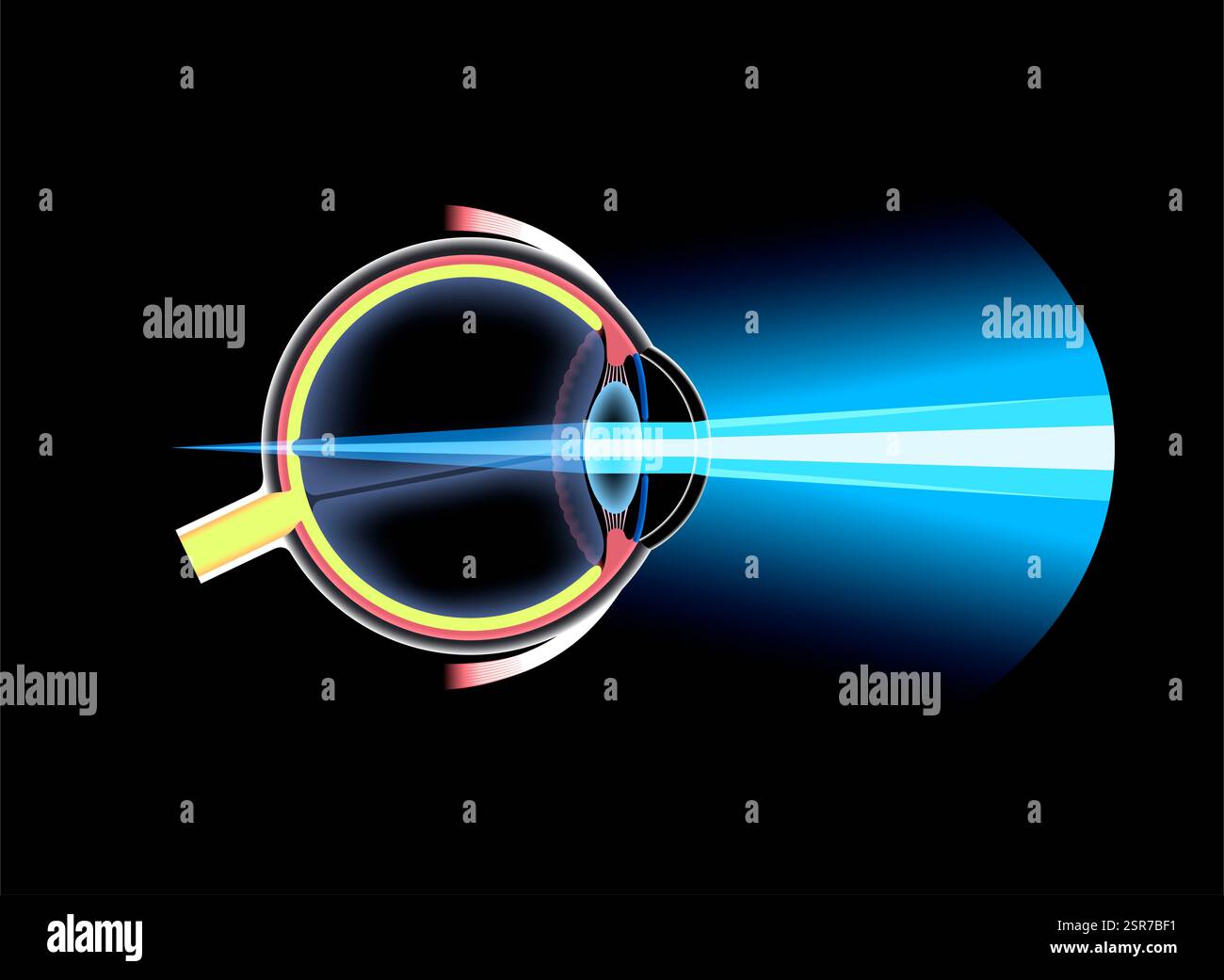 Illustration of farsightedness. Farsightedness, or hyperopia, is a ...