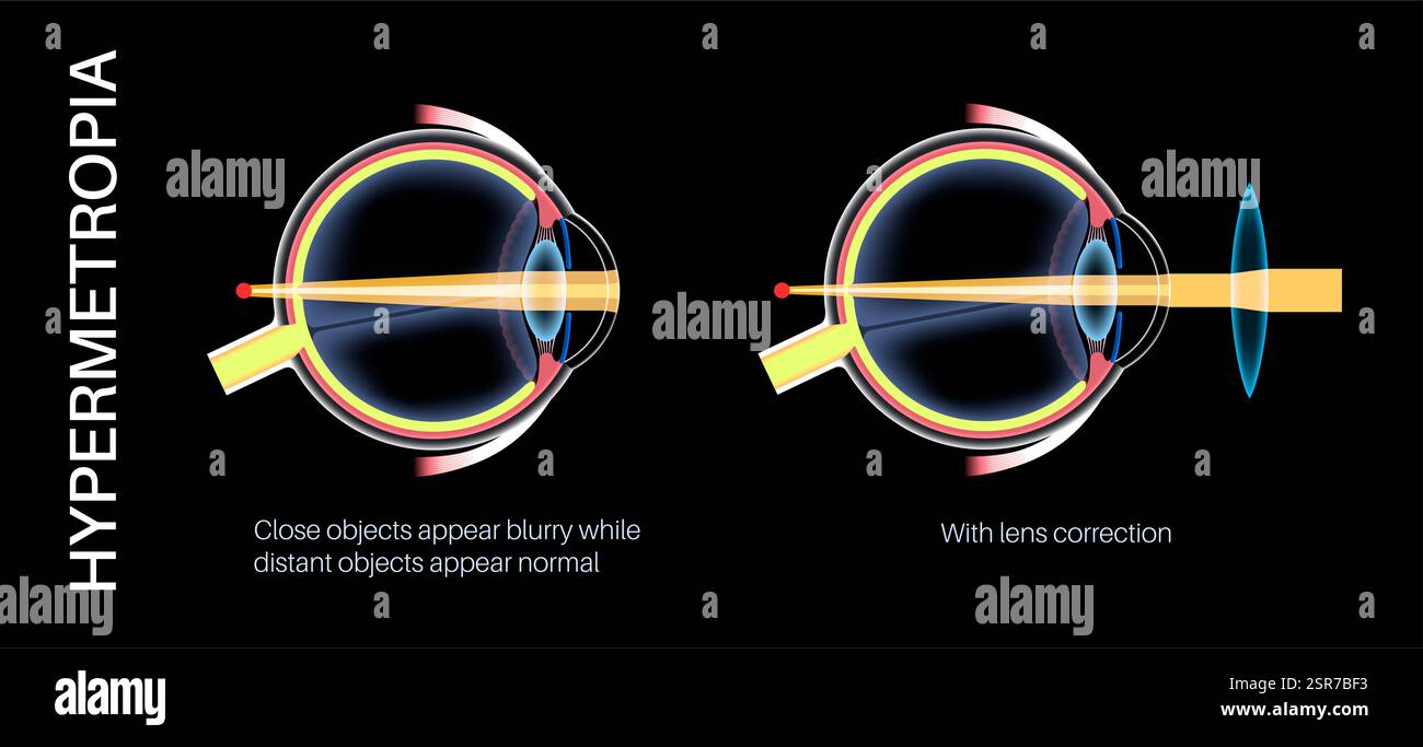 Illustration of farsightedness vision correction. Farsightedness, or ...