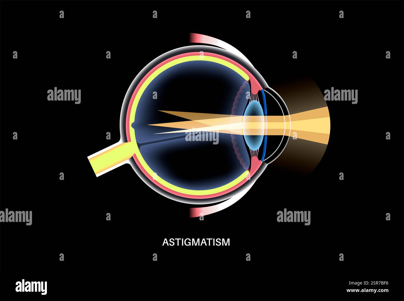 Illustration of the astigmatism eye condition. Astigmatism is an ...