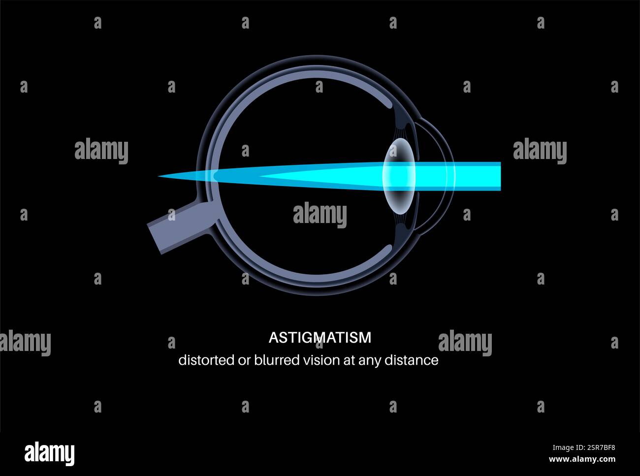 Illustration of the astigmatism eye condition. Astigmatism is an ...
