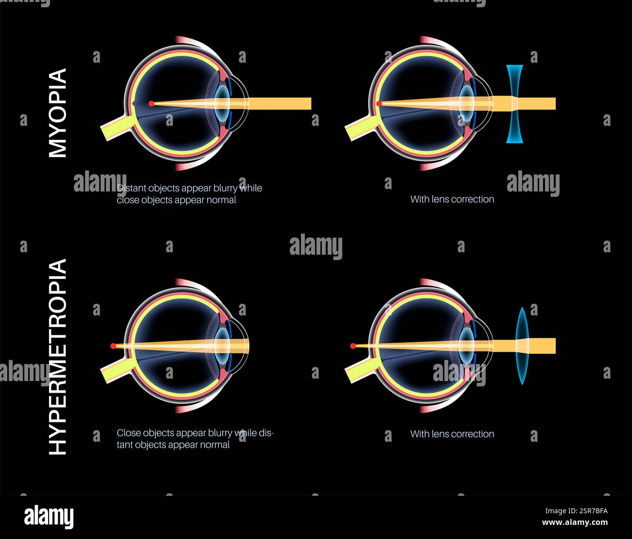 Illustration of nearsightedness and farsightedness vision correction. Nearsightedness, or myopia ...