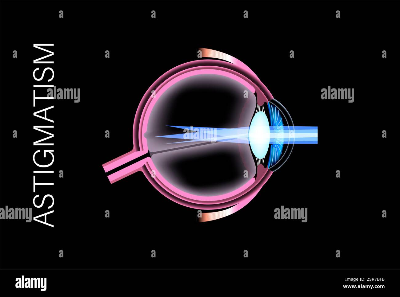 Illustration of the astigmatism eye condition. Astigmatism is an imperfection in the curvature ...