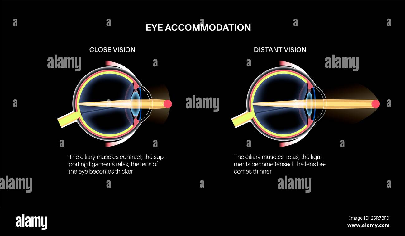 Illustration of eye accommodation. Accommodation is the process of ...
