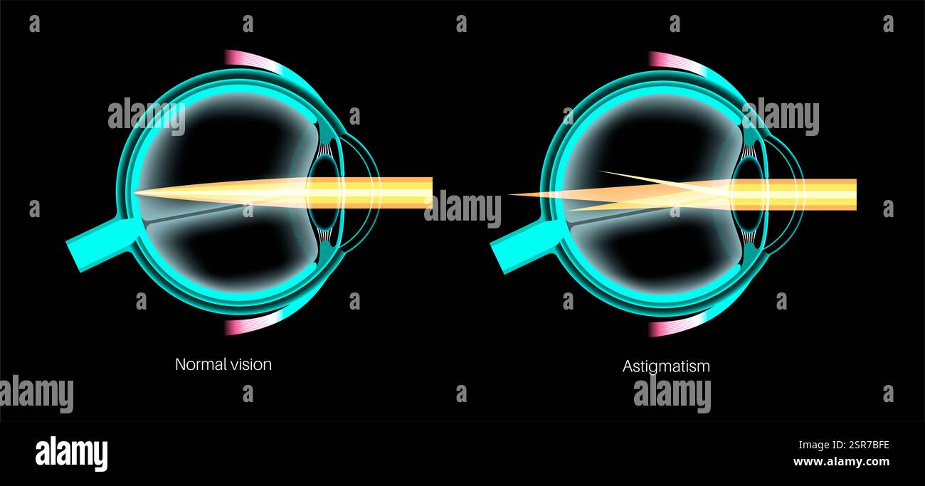 Illustration of the astigmatism eye condition. Astigmatism is an ...