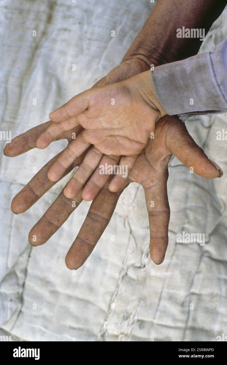 Six finger family, boy hand on man hand palm, photo feature, india ...